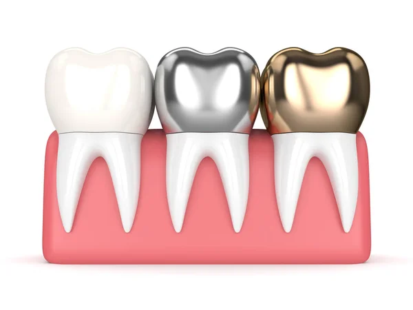 Essential Guide to Dental Crowns Care for Long-lasting Oral Health ...